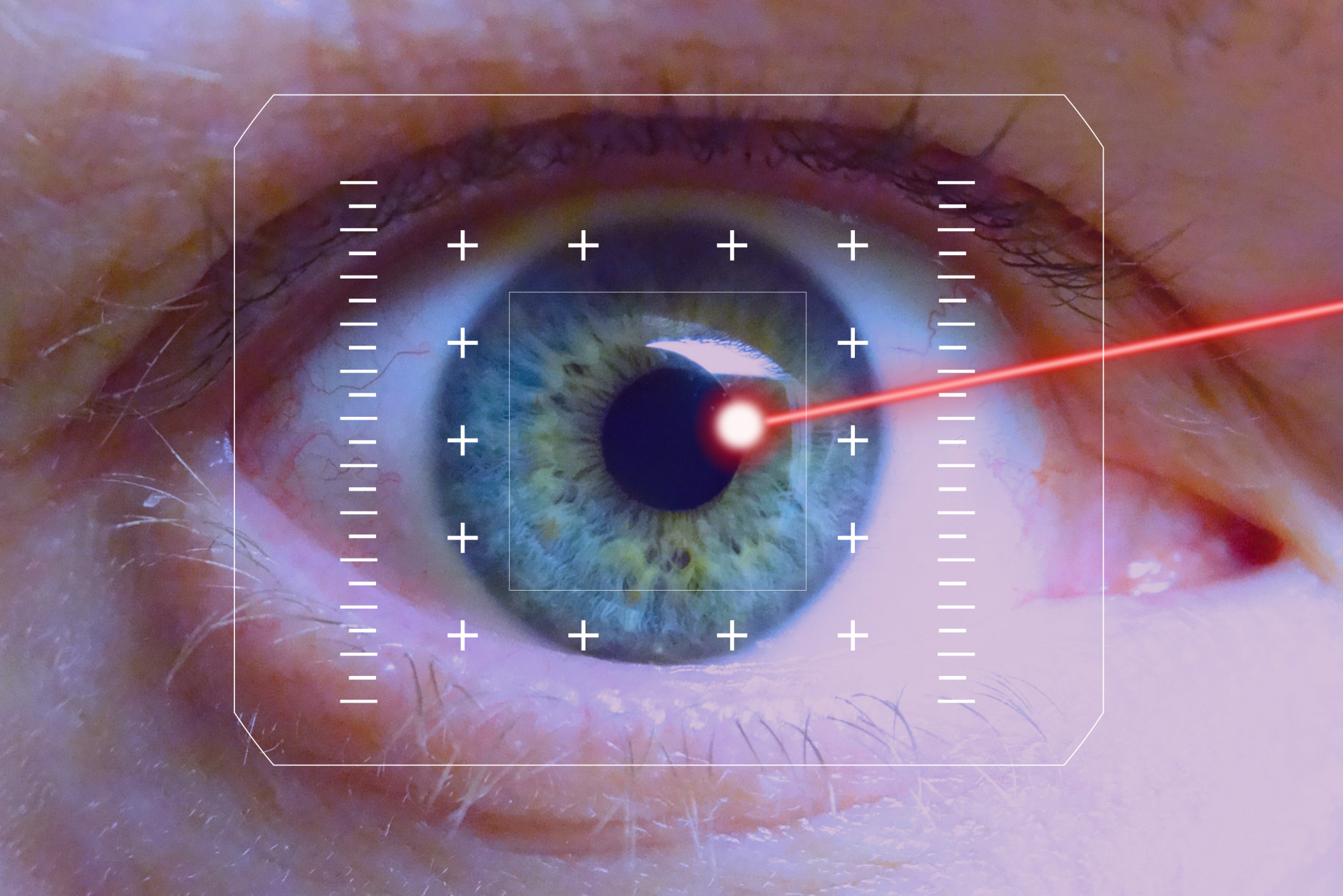 The 6 Qualities of A LASIK Eye Surgery Candidate - Laser Refractive Surgery